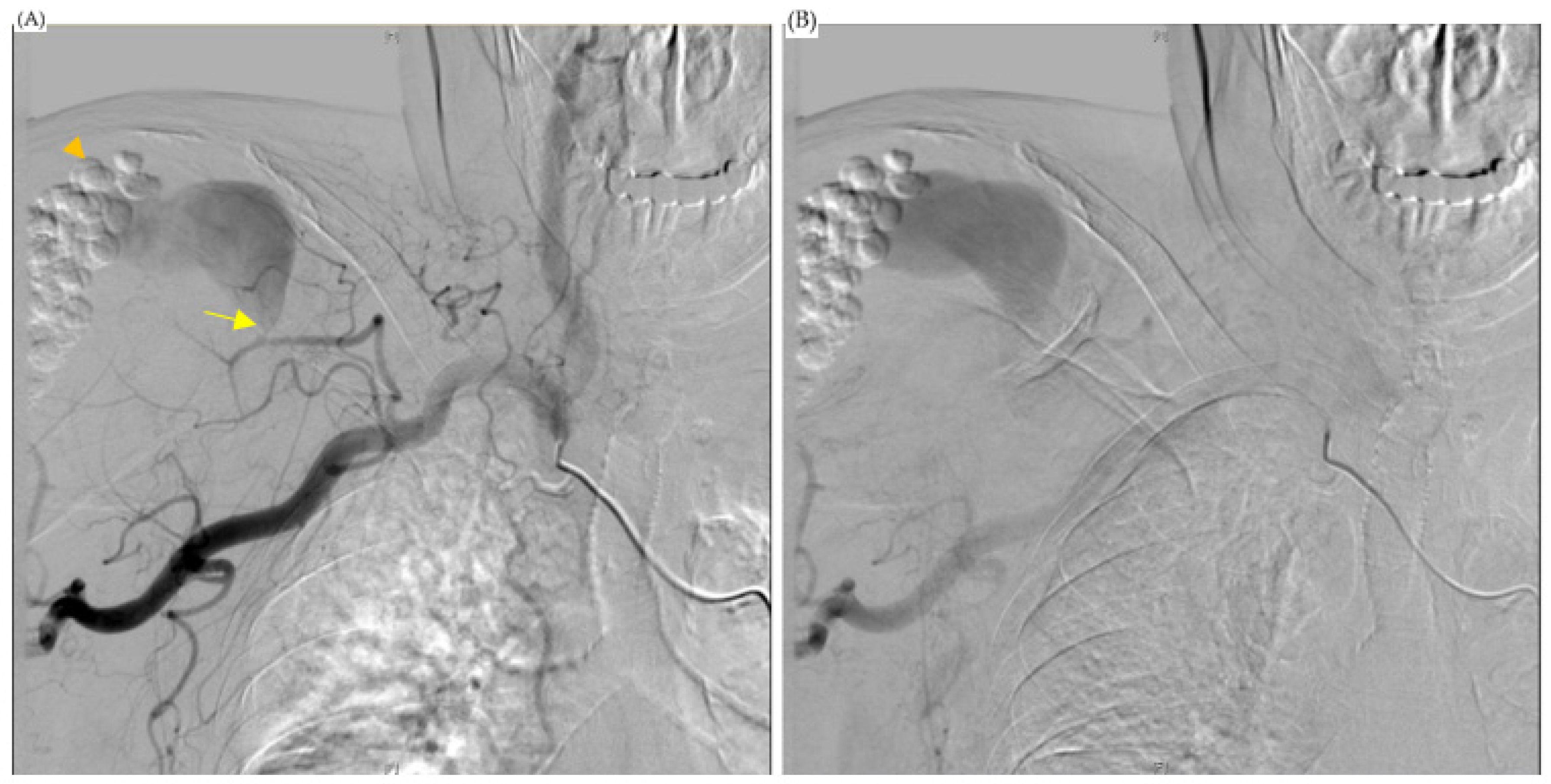 Differential Diagnosis of Thoracoacromial Artery Pseudoaneurysm from ...