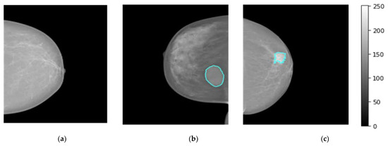 ETECADx: Ensemble Self-Attention Transformer Encoder for Breast Cancer ...