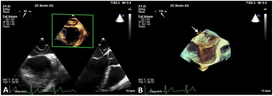 Cor Triatriatum Sinister Presenting as Cardioembolic Stroke in a Young ...