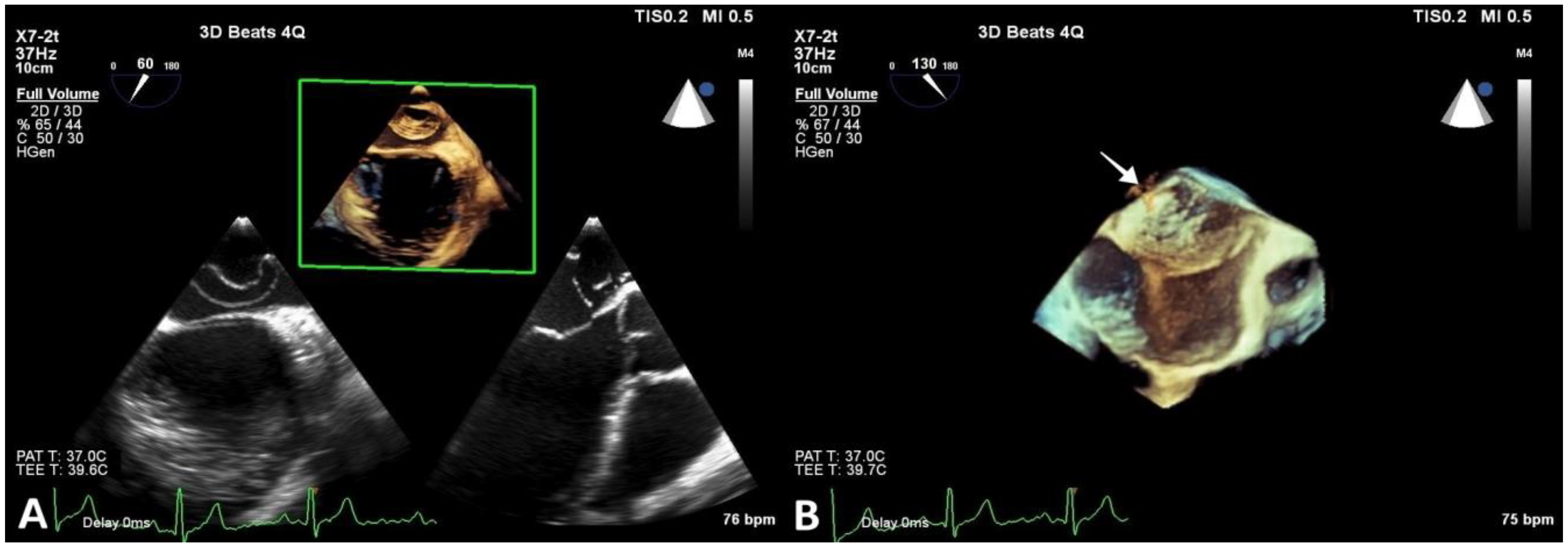 Cor Triatriatum Sinister Presenting as Cardioembolic Stroke in a Young ...