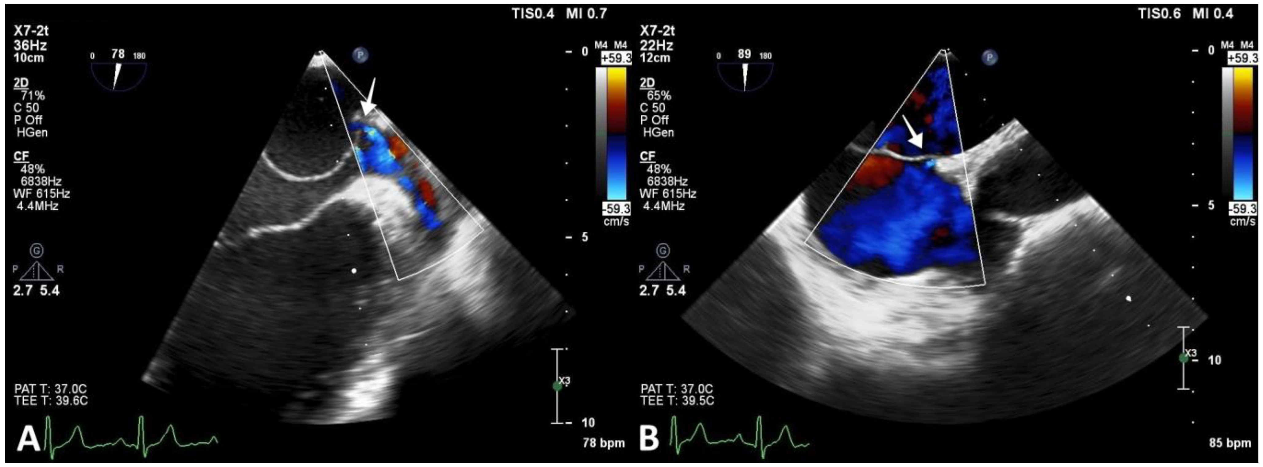 Cor Triatriatum Sinister Presenting as Cardioembolic Stroke in a Young ...