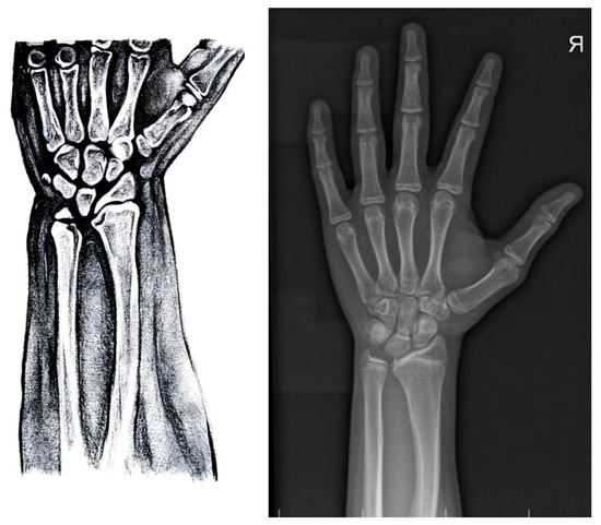SHOX Deletion and Idiopathic Short Stature: What Does the Clinician ...