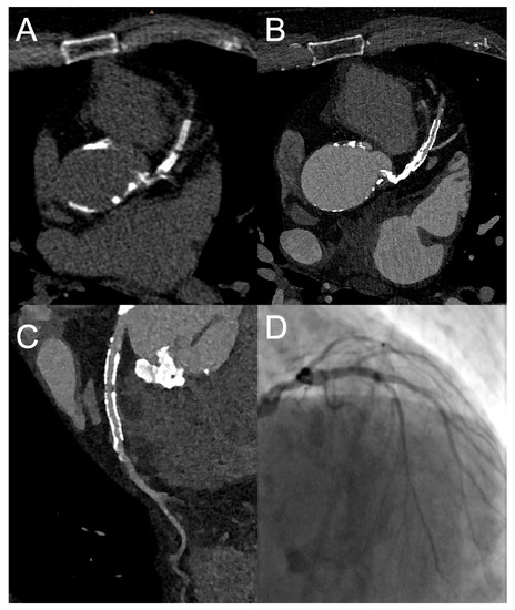 Diagnostics | Free Full-Text | Coronary Computed Tomography vs. Cardiac Magnetic Resonance ...