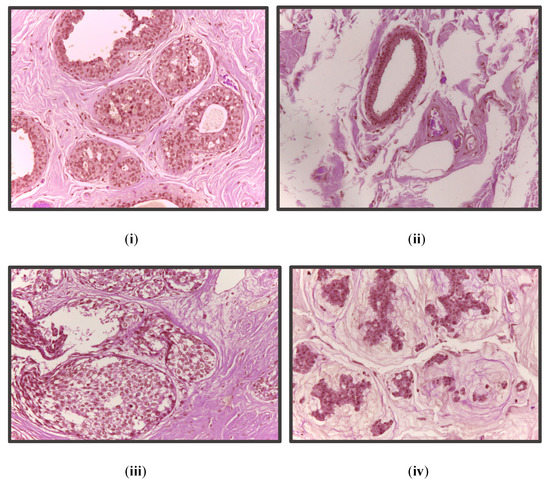 Diagnostics | Free Full-Text | A Multi-Stage Approach to Breast Cancer ...