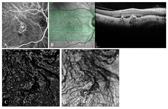 A Comparative Study of Choroidal Vascular and Structural ...