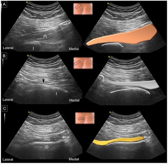 Ischiofemoral Impingement Syndrome: Clinical and Imaging/Guidance ...