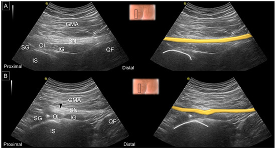 Obturator Internus Muscle Ultrasound