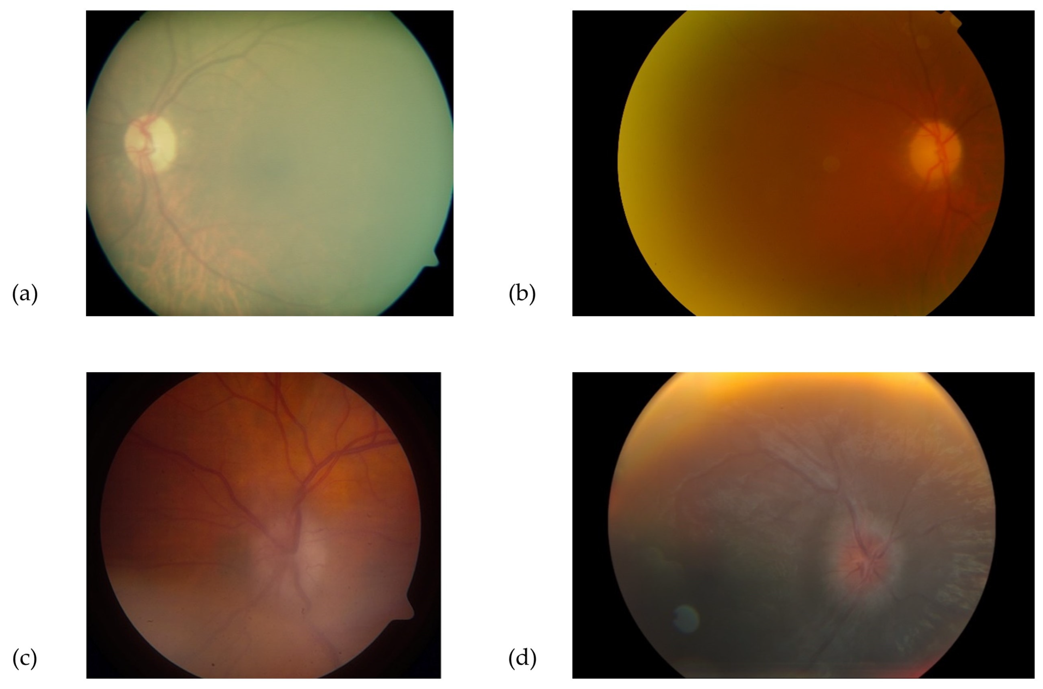 A Deep Learning System for Automated Quality Evaluation of Optic Disc ...