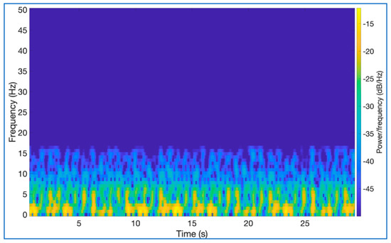 Automated Hypertension Detection Using ConvMixer and Spectrogram Techniques with ...