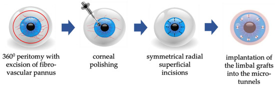 Diagnostic Algorithm for Surgical Management of Limbal Stem Cell Deficiency