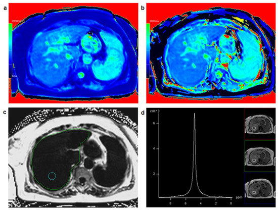 Water–Fat Separated T1 Mapping in the Liver and Correlation to Hepatic ...