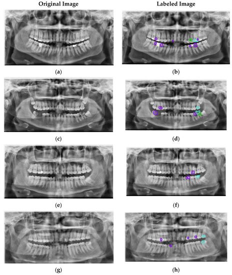 A Novel Deep Learning-Based Approach for Segmentation of Different Type Caries Lesions on ...
