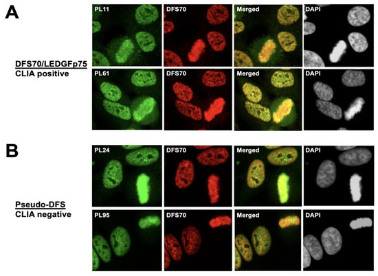The Nuclear Dense Fine Speckled (DFS) Immunofluorescence Pattern: Not ...