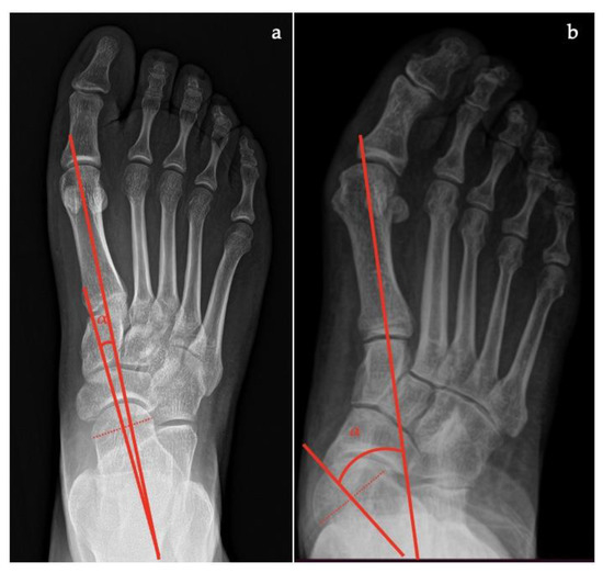 Adult Acquired Flatfoot Deformity: A Narrative Review about Imaging ...