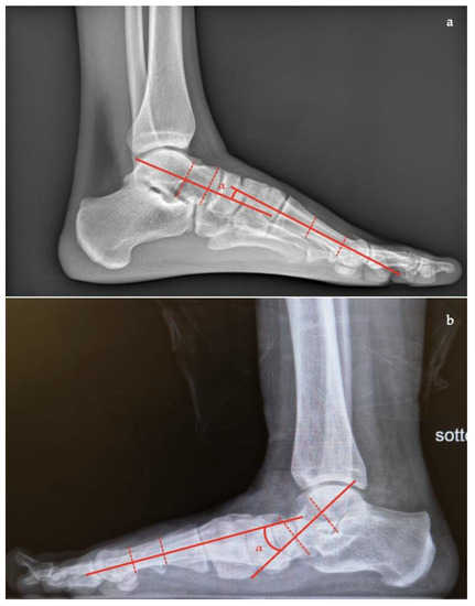 Adult Acquired Flatfoot Deformity: A Narrative Review about Imaging ...