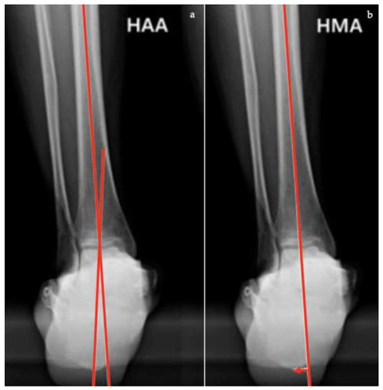 Adult Acquired Flatfoot Deformity: A Narrative Review about Imaging ...