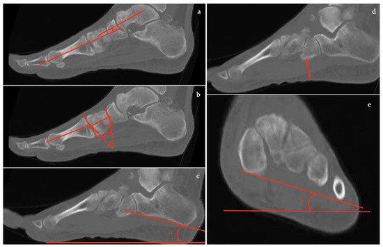 Adult Acquired Flatfoot Deformity: A Narrative Review about Imaging ...