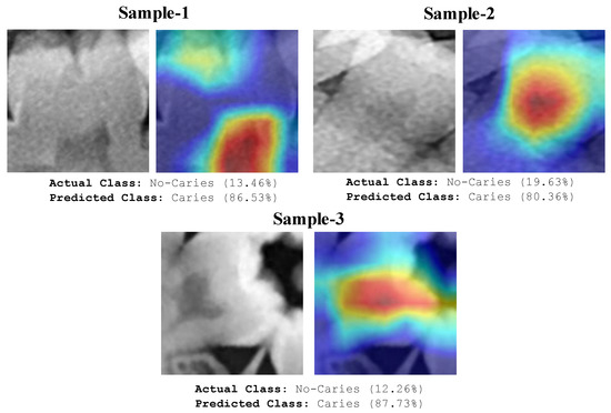 An Explainable Deep Learning Model to Prediction Dental Caries Using Panoramic Radiograph Images