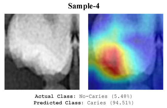 An Explainable Deep Learning Model to Prediction Dental Caries Using Panoramic Radiograph Images