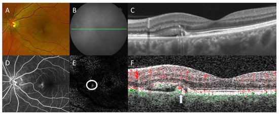 OCT and OCT Angiography Update: Clinical Application to Age-Related ...