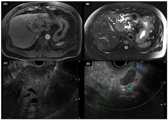 Diagnosis of Cholangiocarcinoma