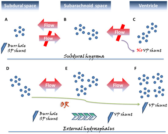Subdural Lesions Linking Additional Intracranial Spaces and Chronic ...