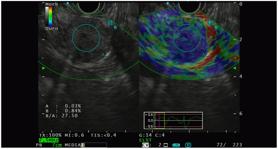 Contrast Enhanced EUS for Predicting Solid Pancreatic Neuroendocrine ...