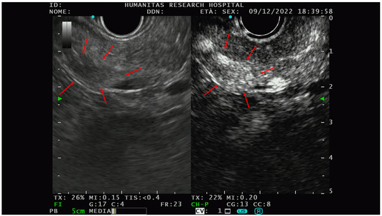 Contrast Enhanced EUS for Predicting Solid Pancreatic Neuroendocrine ...