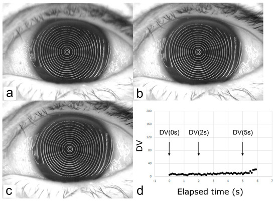 Successful Detection of the Characteristics of Tear Film Breakup ...