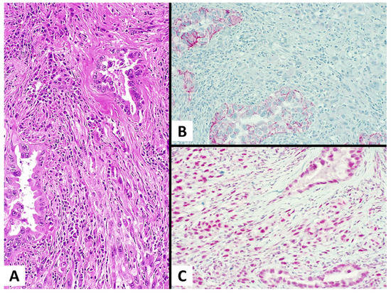Immunohistochemistry for Claudin-4 and BAP1 in the Differential ...