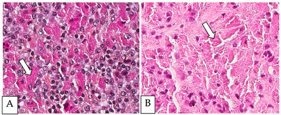 Crystal-Storing Histiocytosis: The Iceberg of More Serious Conditions