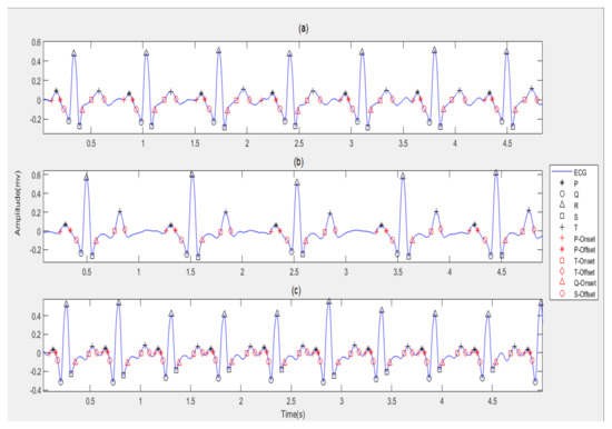 Advanced Time-Frequency Methods for ECG Waves Recognition