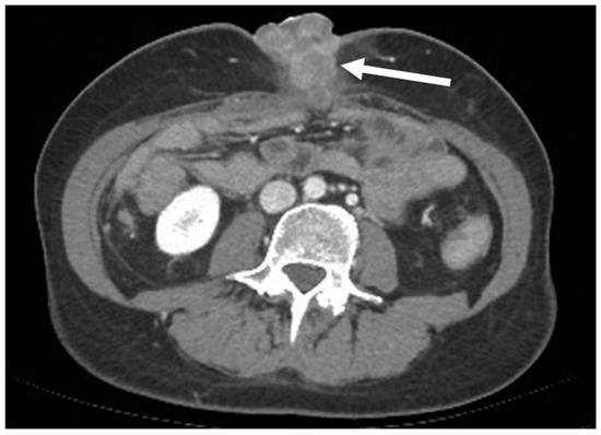The Neoplastic Side of the Abdominal Wall: A Comprehensive Pictorial ...