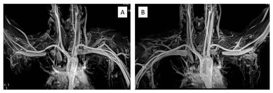 Clinical Significance of Maximum Intensity Projection Method for ...