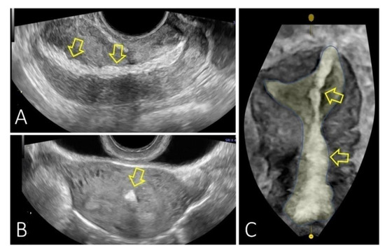 Uterine Perforation as a Complication of the Intrauterine Procedures ...