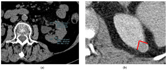 The Role of CT Imaging in Characterization of Small Renal Masses