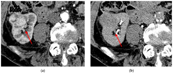 The Role of CT Imaging in Characterization of Small Renal Masses