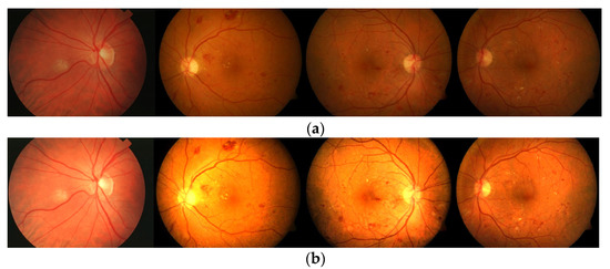 Retinal Blood-Vessel Extraction Using Weighted Kernel Fuzzy C-Means Clustering and Dilation ...