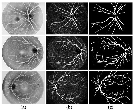 Retinal Blood-Vessel Extraction Using Weighted Kernel Fuzzy C-Means Clustering and Dilation ...