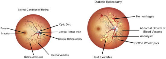 Diagnostics | Free Full-Text | A Survey on Deep-Learning-Based Diabetic Retinopathy Classification