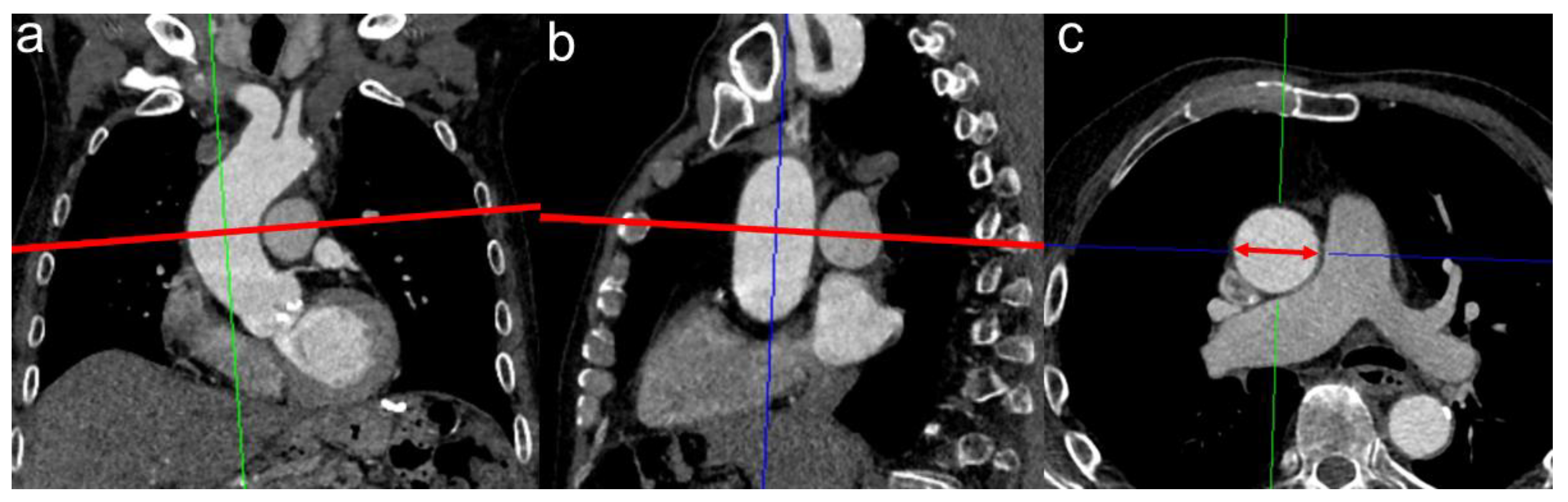 The Presence of Ascending Aortic Dilatation in Patients Undergoing ...