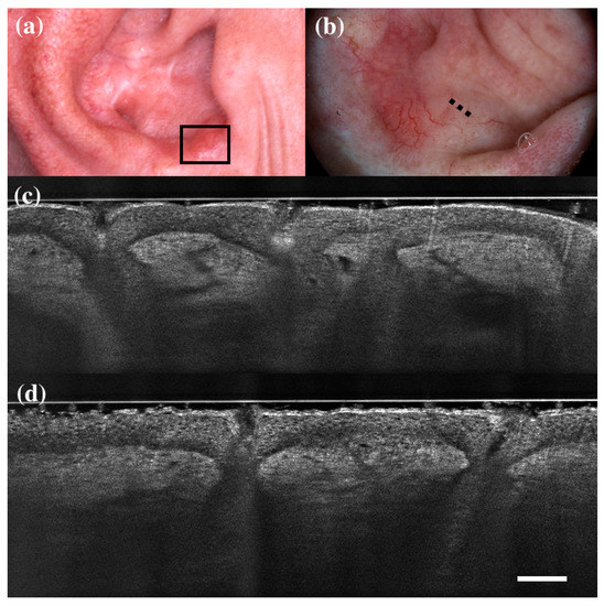 Diagnostic Accuracy of Line-Field Confocal Optical Coherence Tomography ...