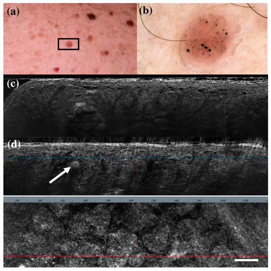 Diagnostic Accuracy of Line-Field Confocal Optical Coherence Tomography ...