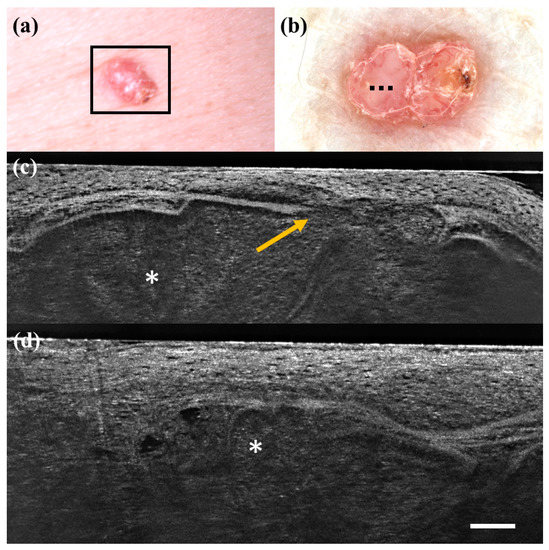Diagnostic Accuracy of Line-Field Confocal Optical Coherence Tomography ...
