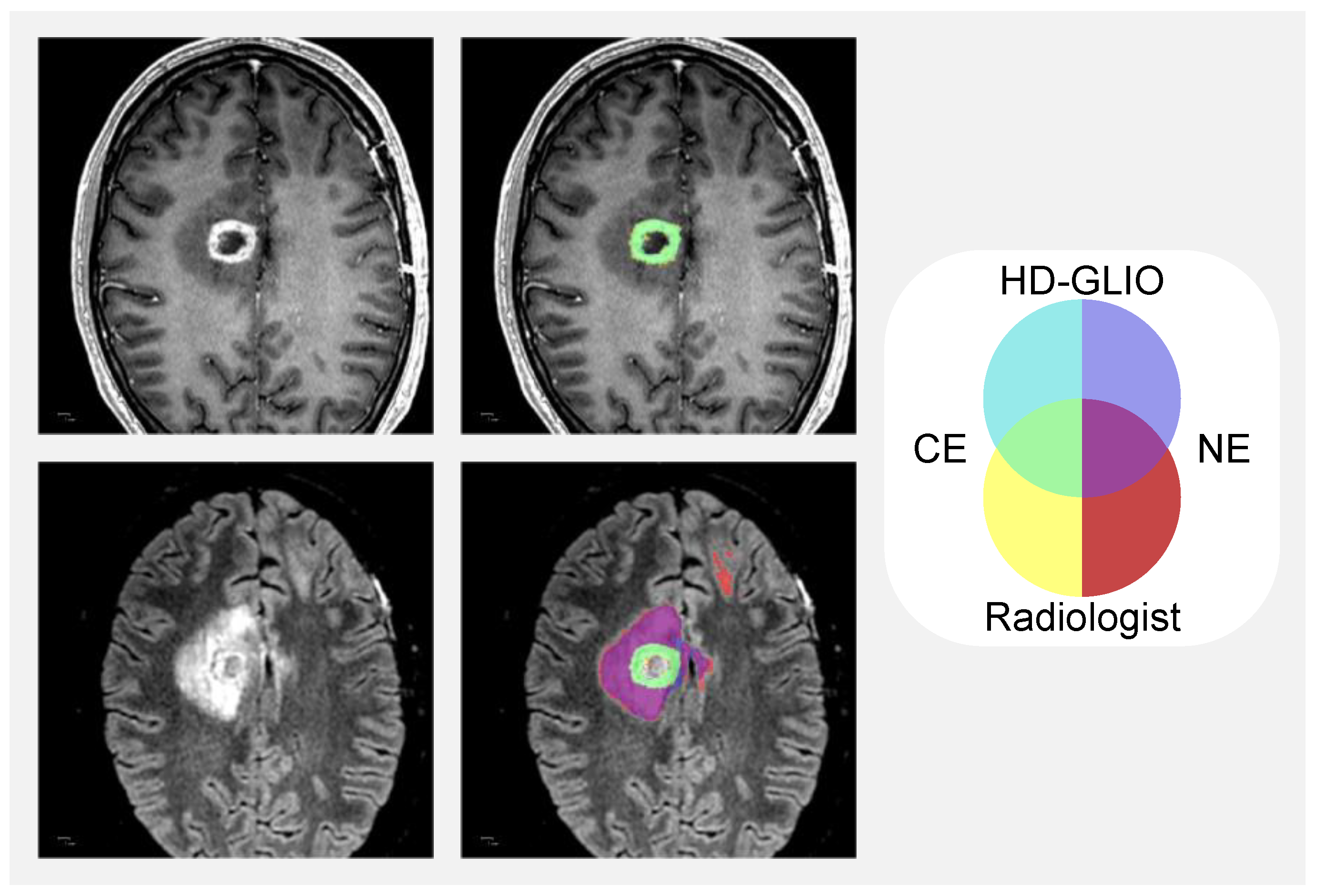 Evaluation of the HD-GLIO Deep Learning Algorithm for Brain Tumour Segmentation on Postoperative MRI