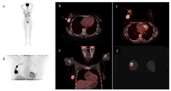 Prone versus Supine FDG PET/CT in the Staging of Breast Cancer