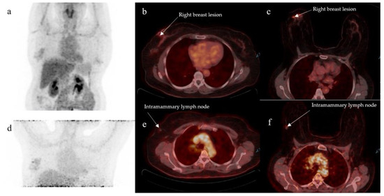 Prone versus Supine FDG PET/CT in the Staging of Breast Cancer