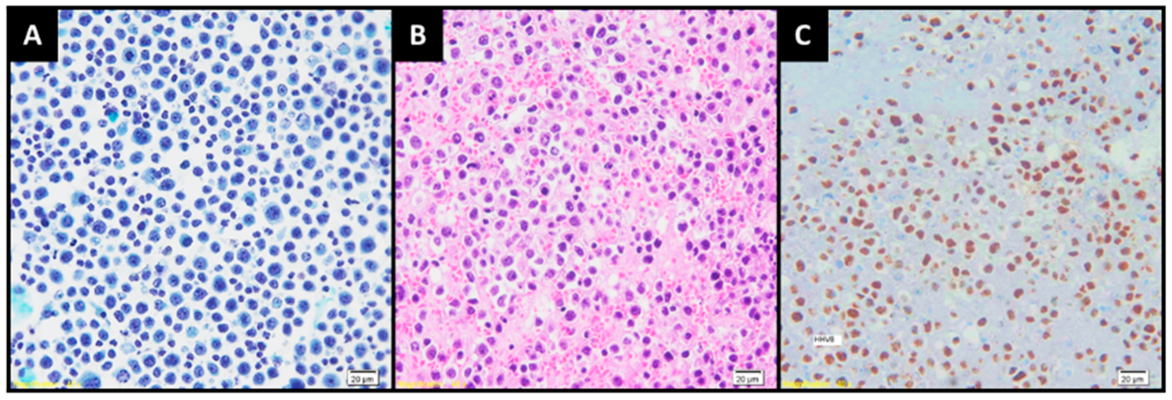 Diagnostics | Free Full-Text | Primary Effusion Lymphoma: A Rare and ...