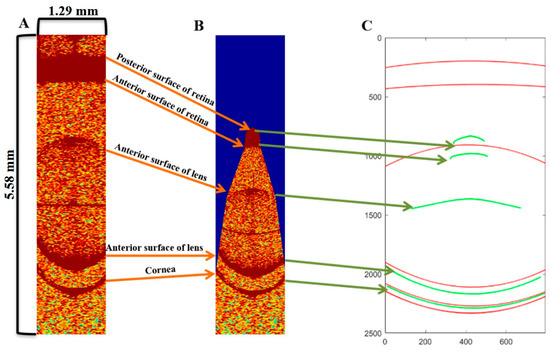 Time-Serial Evaluation of the Development and Treatment of Myopia in ...
