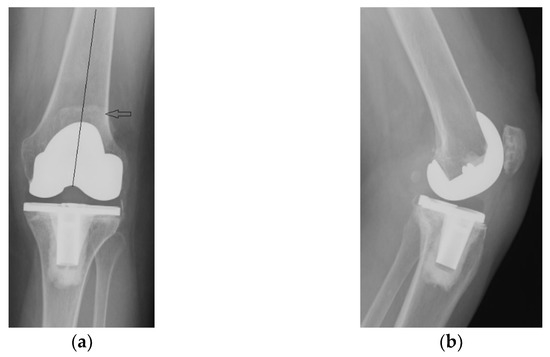 Patellar Resurfacing in Total Knee Arthroplasty, a Never-Ending ...